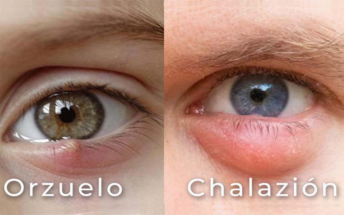 ¿Qué es un orzuelo y un chalazión? Causas, síntomas y tratamientos.