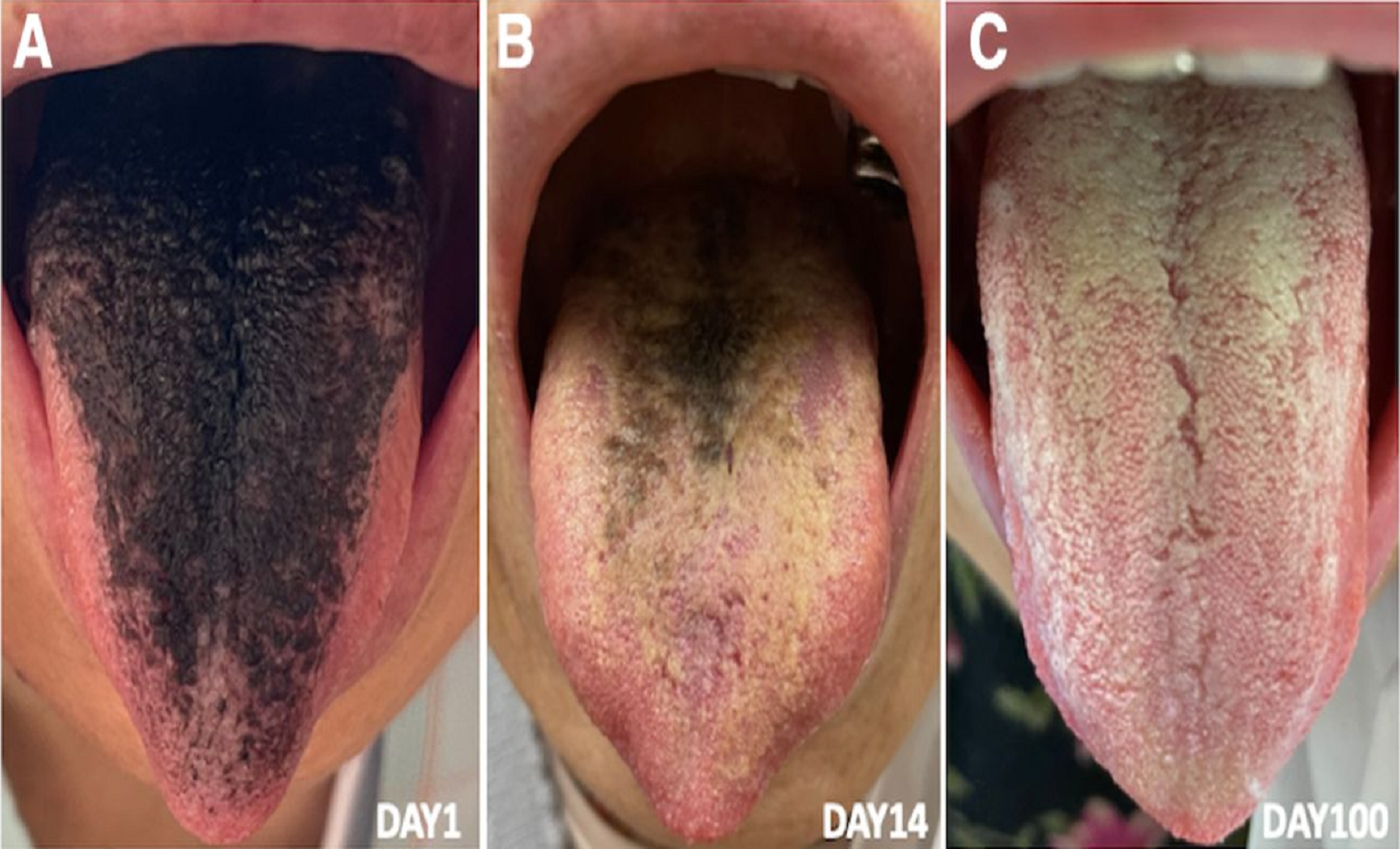 Caso clínico inusual: los antibióticos pueden causar lengua vellosa negra.