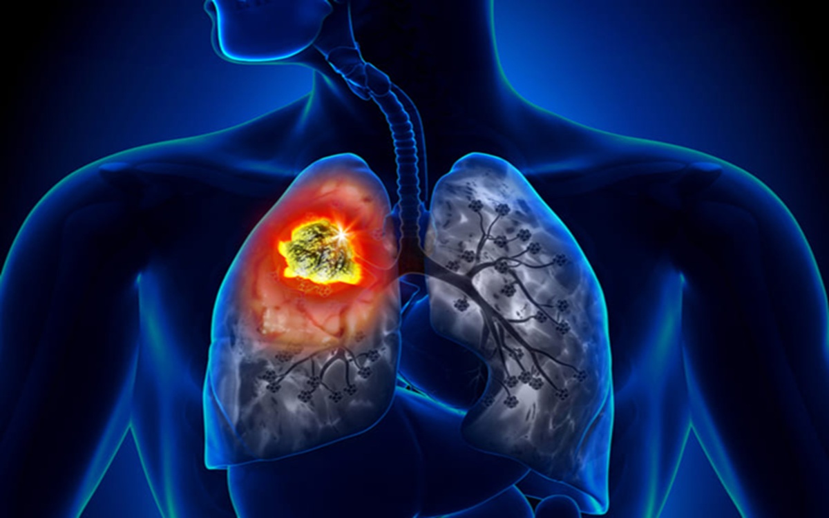 Muy preocupante, el cáncer de pulmón está aumentando en personas que ...